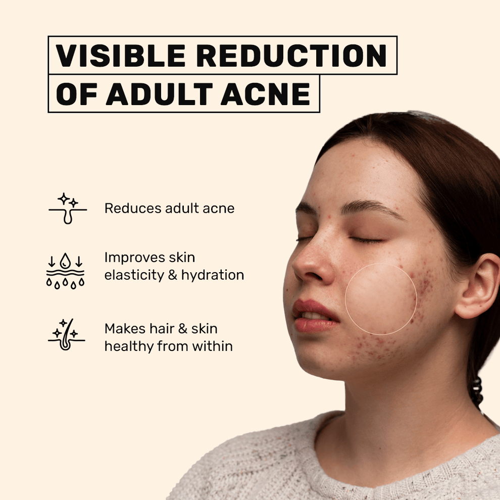 Anti-Acne Collagen - Marine Collagen Powder for Acne & Pimples – What's ...